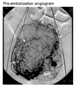 TACE / TACI for Cancer Treatment – BaliMéd Hospital